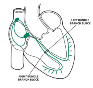 Bundle Branch Block Heart Condition | Bundle Branch Block Causes & Signs